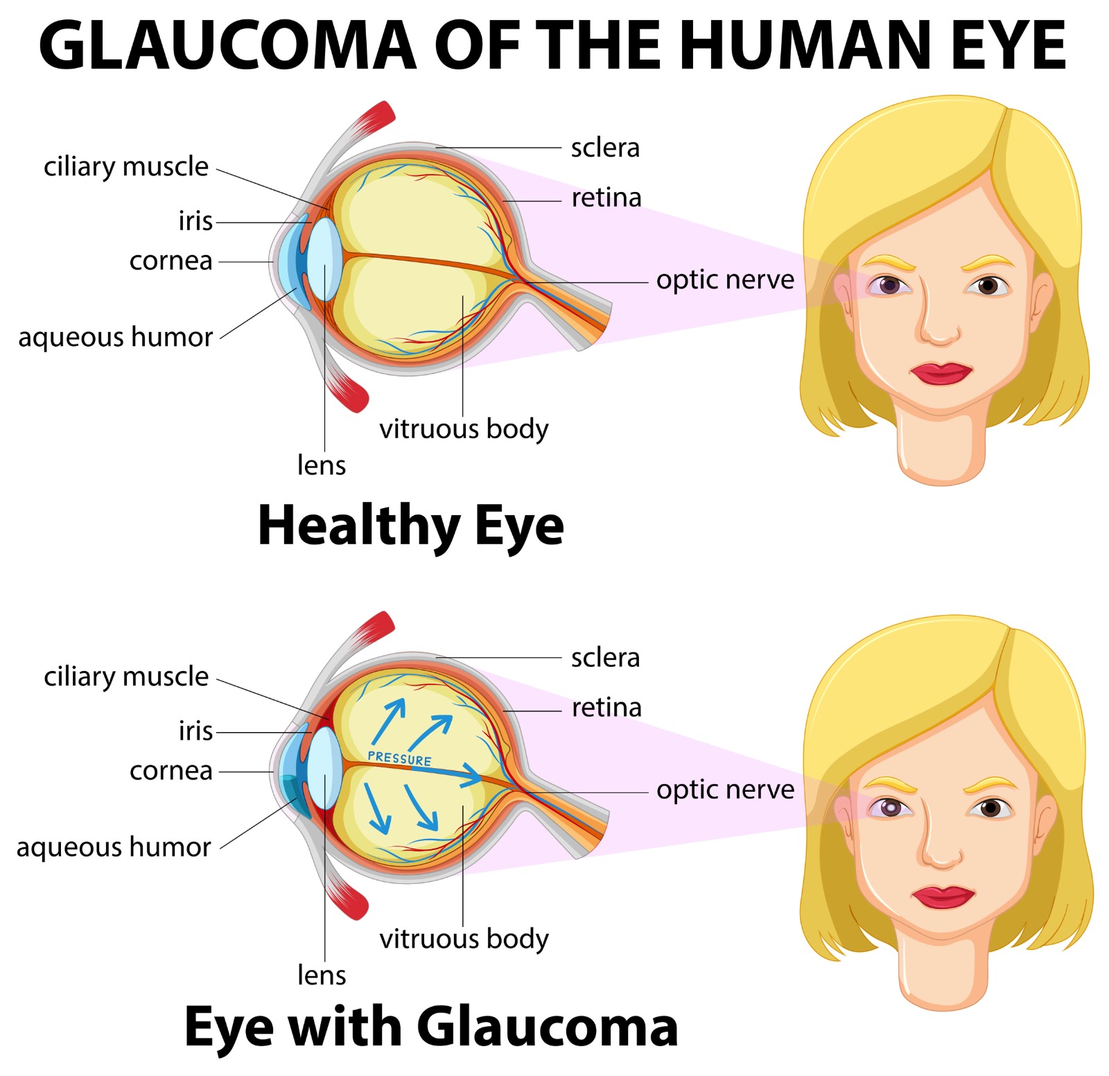 Glaucoma Surgery - Plusify